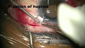 Mastering the Glued IOL Technique - Eyetube