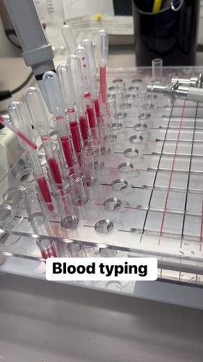 19 reactions · 18 shares | ABO blood typing #bloodtype #bloodtyping #laboratory #medtech #blood #bloodbank | Mama Sweet and Spice | Facebook