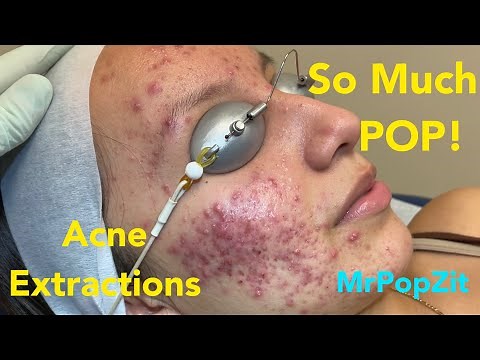So much pop! Acne extractions on severe inflammatory acne. Multiple blackheads and whiteheads.