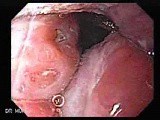 Enlarged tonsils - endoscopic view 2/2, chronic tonsilitis • Video • MEDtube.net