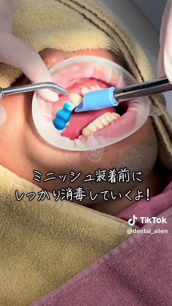 ホワイトニング・矯正前のミニッシュ装着
