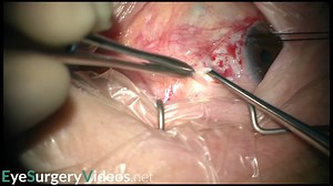 Extraocular muscle biopsy - Oculoplastic | EyeSurgeryVideos.net