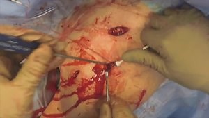 Arthroscopic AC/CC Joint Reconstruction with Allograft and Suspensory Button Fixation