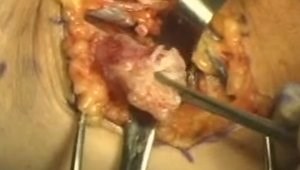 Repair of Acute and Chronic Distal Biceps Ruptures using Suture Anchor Fixation